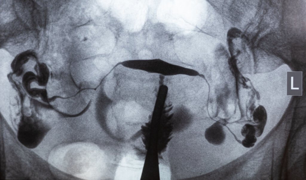 Is an HSG Necessary Before IVF? | American Surrogacy Blog