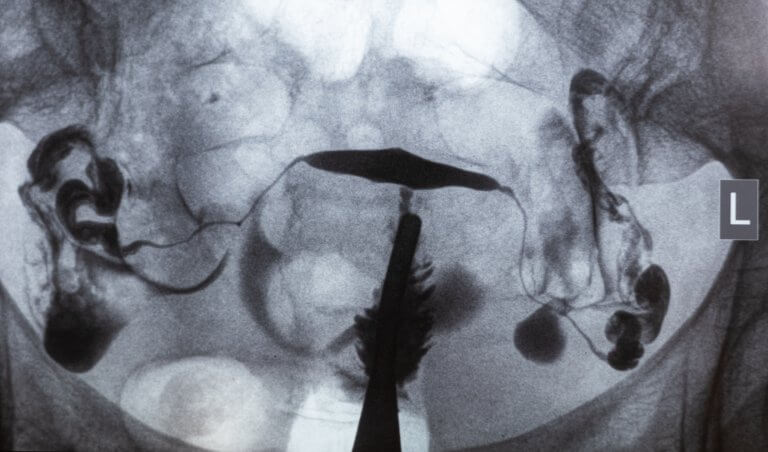 Is an HSG Necessary Before IVF? | American Surrogacy Blog